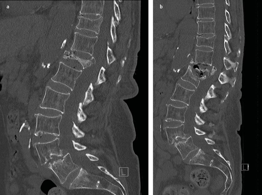 Osteoporotische Frakturen der thorakalen und lumbalen Wirbelsäule - Orthopädie & Traumatologie ...